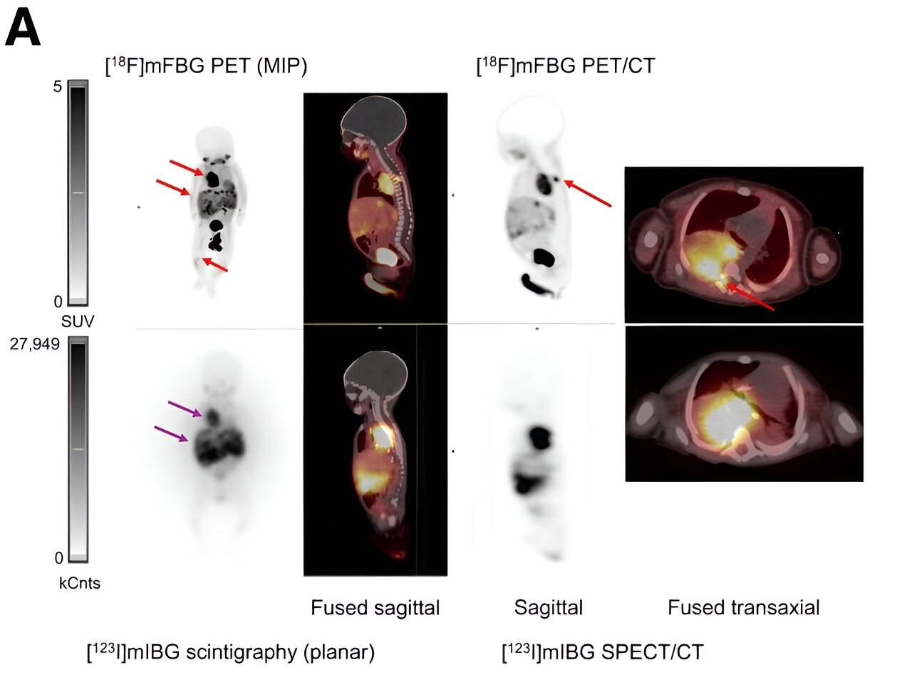 Kỹ thuật PET/CT mới phát hiện chính xác u nguyên bào thần kinh ở trẻ em ...